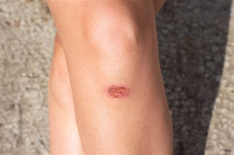 Knees Bleeding Stock Images Search Stock Images On Everypixel