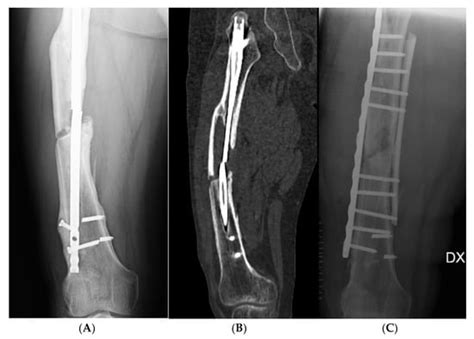 Treatment Of Femoral Shaft Pseudarthrosis Case Series And Medico Legal
