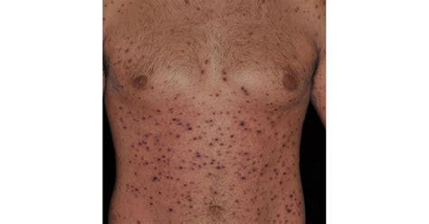 Pitiriasis Liquenoide