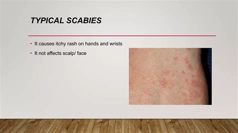 Scabies Pptx