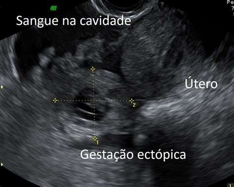 Fundamentos Da Ultrassonografia Em Ginecologia E Obstetrícia Terceiro Ano Medicina Dr Pixel