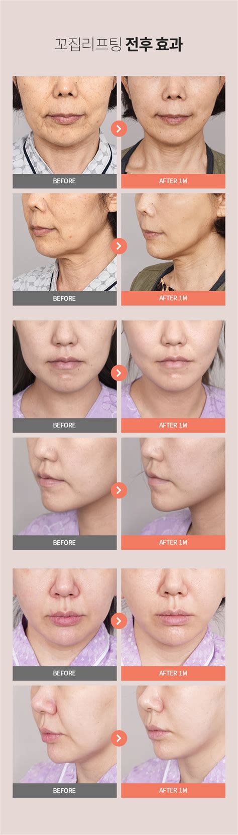 꼬집리프팅 눈도 리프팅도 아이팅성형외과