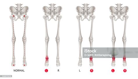 Photo Libre De Droit De Alignement Des Os De La Jambe Normale Ou Os De