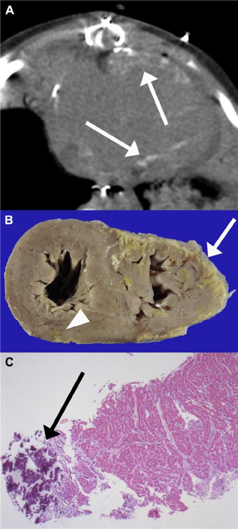E Diffuse Myocardial Calcifications Secondary To Both Local Ie Download Scientific Diagram