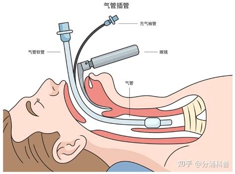 经口气管插管与经鼻气管插管在急危重症患者中的应用对比 知乎