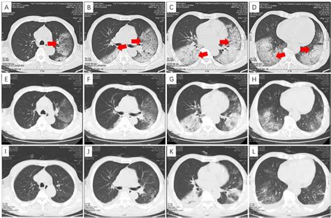 Chest Ct Scan Findings Ad Multiple Lesions In The Lower Lobe Of The Download Scientific