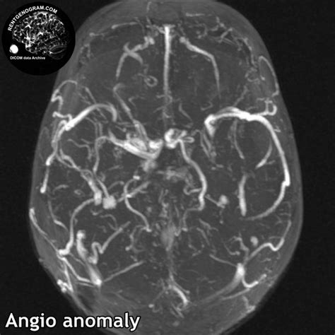МРТ и КТ аномалий развития головного мозга