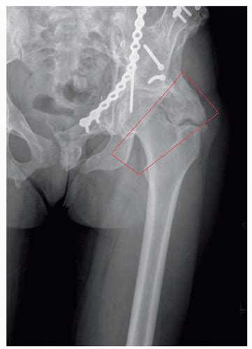 Distal Femoral Replacement Musculoskeletal Key
