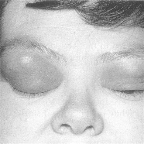 C T Scan Showing A Pansinusitis With Erosion Of The Bony Wall Of The