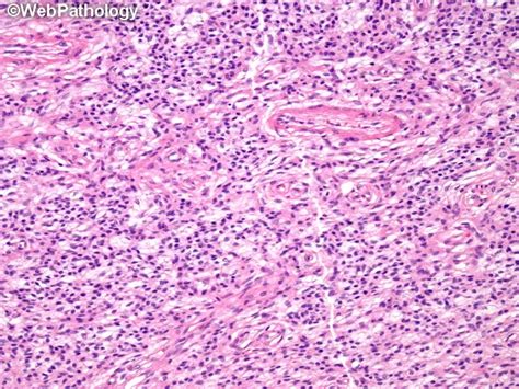 Diffuse Neurofibroma