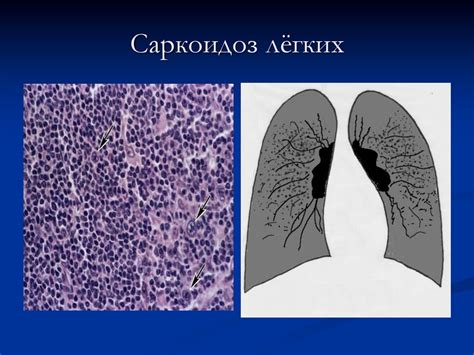 Саркоидоз легких что это такое лечение и симптомы описаны здесь