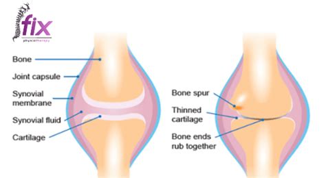 Senaman Berkesan Untuk Lutut Osteoarthritis Oa