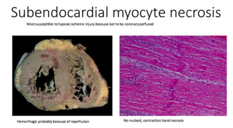 Patho Myocardial Infarction Ihd Flashcards Quizlet