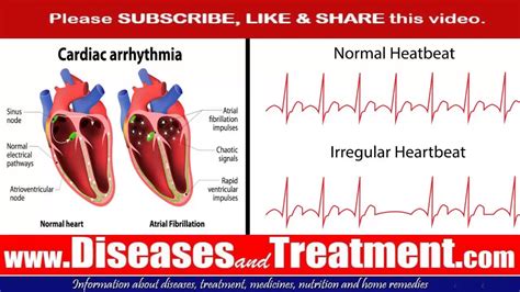 Arrhythmia Causes Symptoms Types And Treatment My Xxx Hot Girl