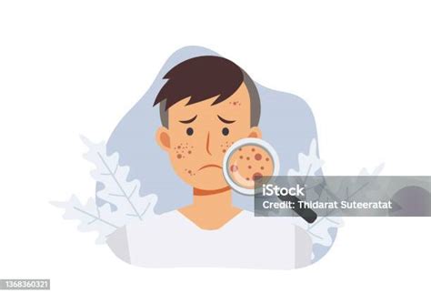 여드름 피부 문제 Conceptman 돋보기와 그의 얼굴에 여드름을 찾고 있다 팔트 벡터 만화 일러스트레이션 피부과 전문의에 대한 스톡 벡터 아트 및 기타 이미지 Istock