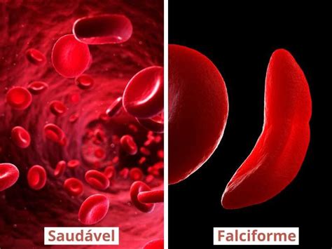Anemia Falciforme Sintomas Causas E Tratamento Boaconsulta
