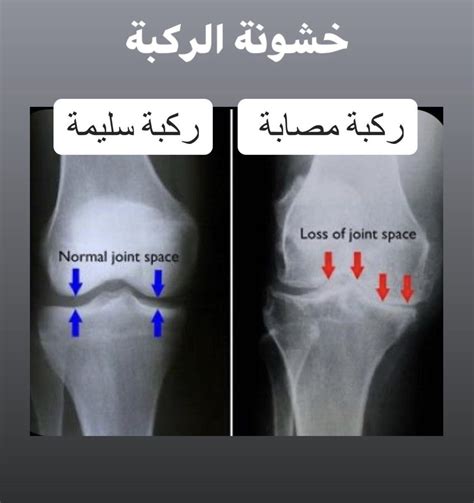 فحشر ونادى هذا بيان للناس خشونةالركبة احتكاكالركبة