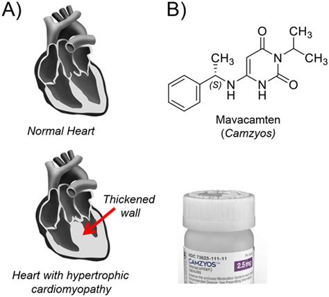 New Era Mavacamten For Obstructive Hypertrophic Cardiomyopathy