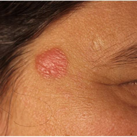 Circular Erythematous Plaque With Sharp Edges And Smooth Surface