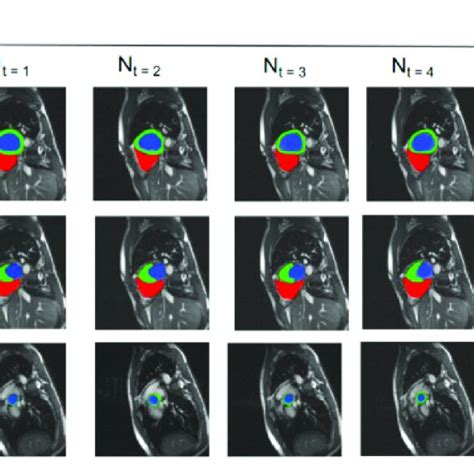 predicted segmentation from stage ed to stage es red areas represent