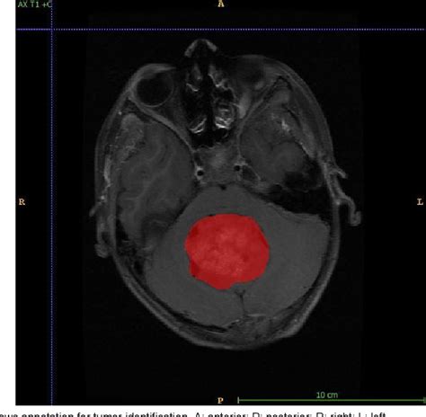Figure 1 From Deep Learning Based Clinico Radiological Model For