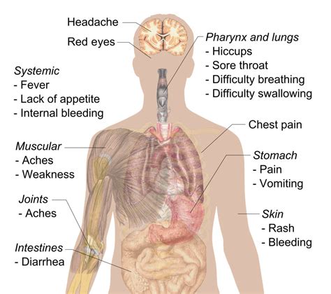 Virus Del Ebola Y Marburgo Concise Medical Knowledge