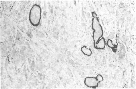 This Lobular Invasive Carcinoma Grade Ii Iii Which Figure 5 This