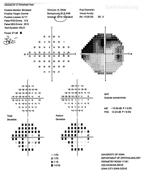 What Is A Visual Field Test For Glaucoma At Michael Thornton Blog