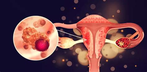 Kanser Ovari Nak Makan And Minum Apa Ini 3 Bahan Penting