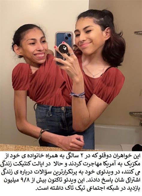 23 Year Old Conjoined Twins Share Their Experiences On What Its Truly