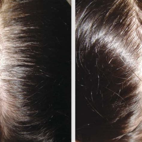 PDF Clinical And Histological Challenge In The Differential Diagnosis Of Diffuse Alopecia