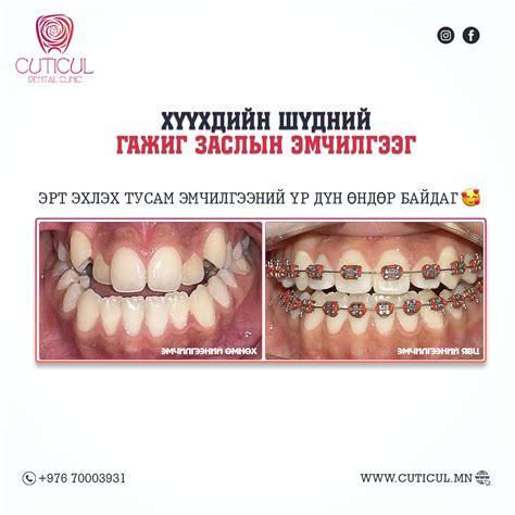Cuticul Dental Clinic Хичээлийн амралтын хугацаанд хүүхдийнхээ зуултын төлөв байдлыг эрт