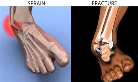 Fractured Ankle Vs Sprained