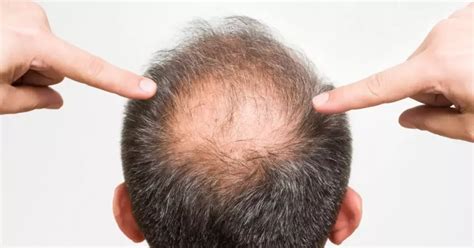 Understanding Hair Miniaturization Causes Signs And Treatment Options