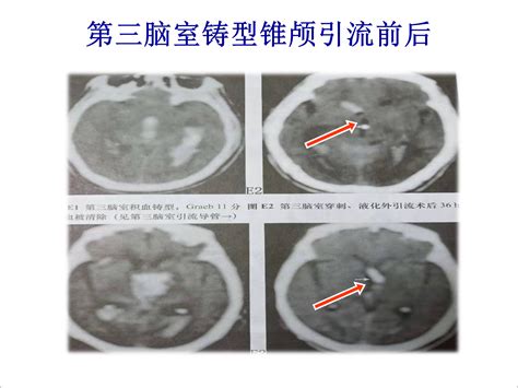 改良立体定位脑出血微创锥颅引流 脑医汇
