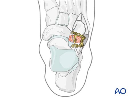 Primary Fusion Of Unreconstructable Calcaneocuboid Joint