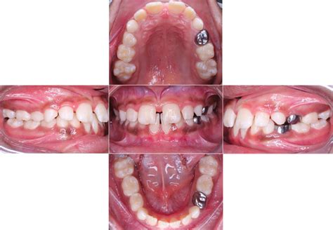 Behavioral And Dental Management Of A Pediatric Patient Diagnosed With