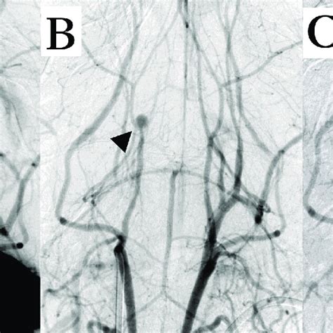 In Vivo Dsa Showed Intracranial Pseudoaneurysms In Three C57bl 6j Mice Download Scientific