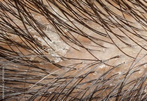 Dandruff Scalp Close Up