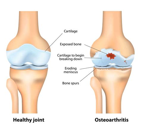 Osteoarthritis Causes Symptoms And Treatment Options