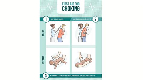 How To Do The Heimlich Maneuver In A Choking Emergency Fox News