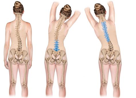 Lumbar Scoliosis Treatment Scoliosis Sos