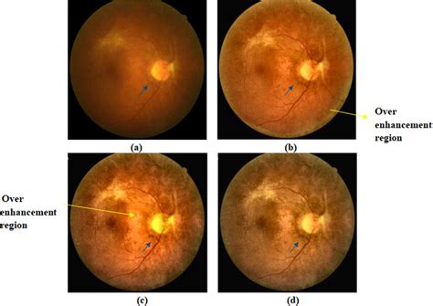 Enhancement Output Of Low Contrast Image In Proprietary Data Set A