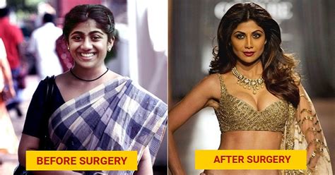 11 Bollywood Actress Who Have Allegedly Undergone Plastic Surgery