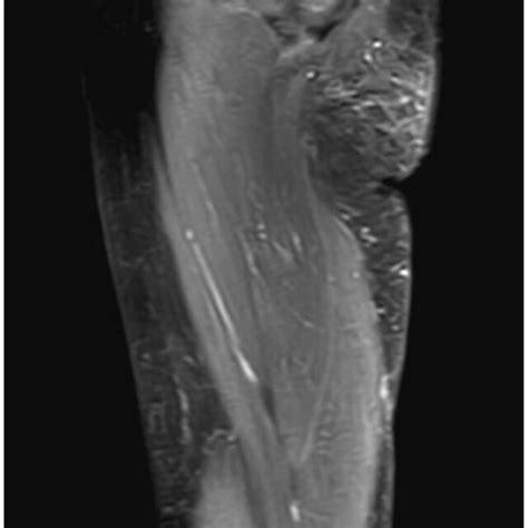 Right Thigh Mri Showed No Obvious Abnormal Signal In Subcutaneous And