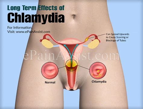 Long Term Effects Of Chlamydia