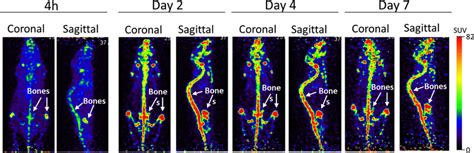 Representative Coronal And Sagittal Pet Maximum Intensity Projection