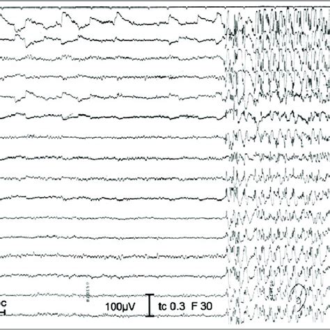 Patient 6 73 Years Female Jme Onset At Age Of 15 Years She Was