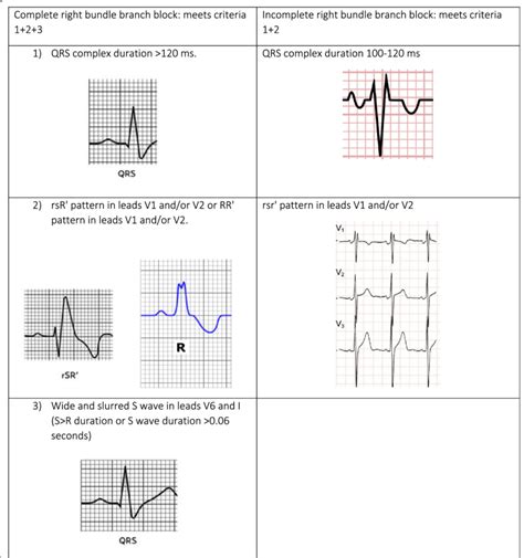 Diagnostic Criteria For Right Bundle Branch Block 18 19 Download Scientific Diagram
