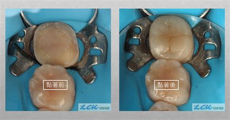 保存粹齒 林俊國醫師 活髓治療與陶瓷嵌體復形實際病例二